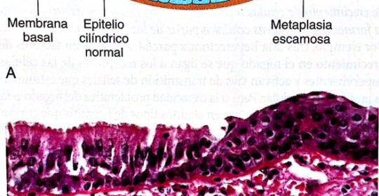 La Metaplasia Intestinal Gastrica es una lesion precancerosa